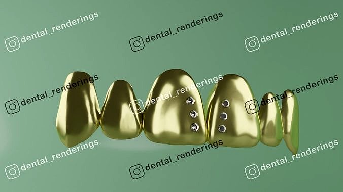Grillz with diamonds in the front teeth 3d model