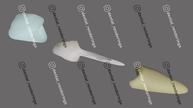 Fiber post and core with single crown - Anterior tooth 3d model