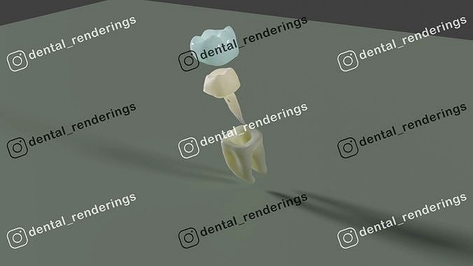 Fiber post and core with single crown - Posterior tooth 3d model