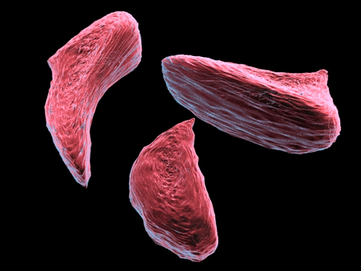 Sickle Cell Anaemia max 3d model