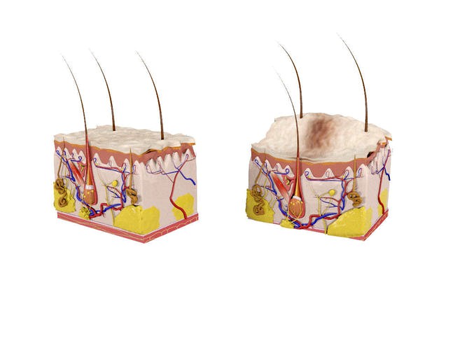 Skin layers Epidermis dermis Injections 3d model